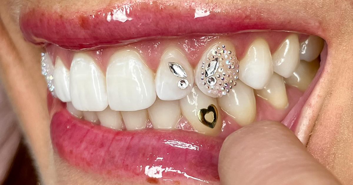 Gemini Smile | Tooth Gem Services & Products